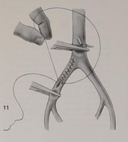 Upgrading a prior 🧵regarding polypropylene ('Prolene') suture: the ...