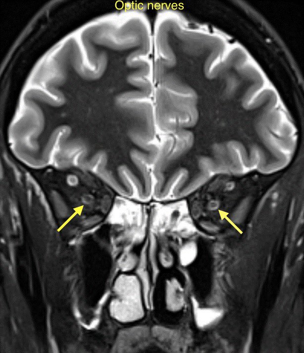 Imaging Quick Tips & Tricks for Cranial Neuropathies 🧠 A neuroimaging 🧵 ...