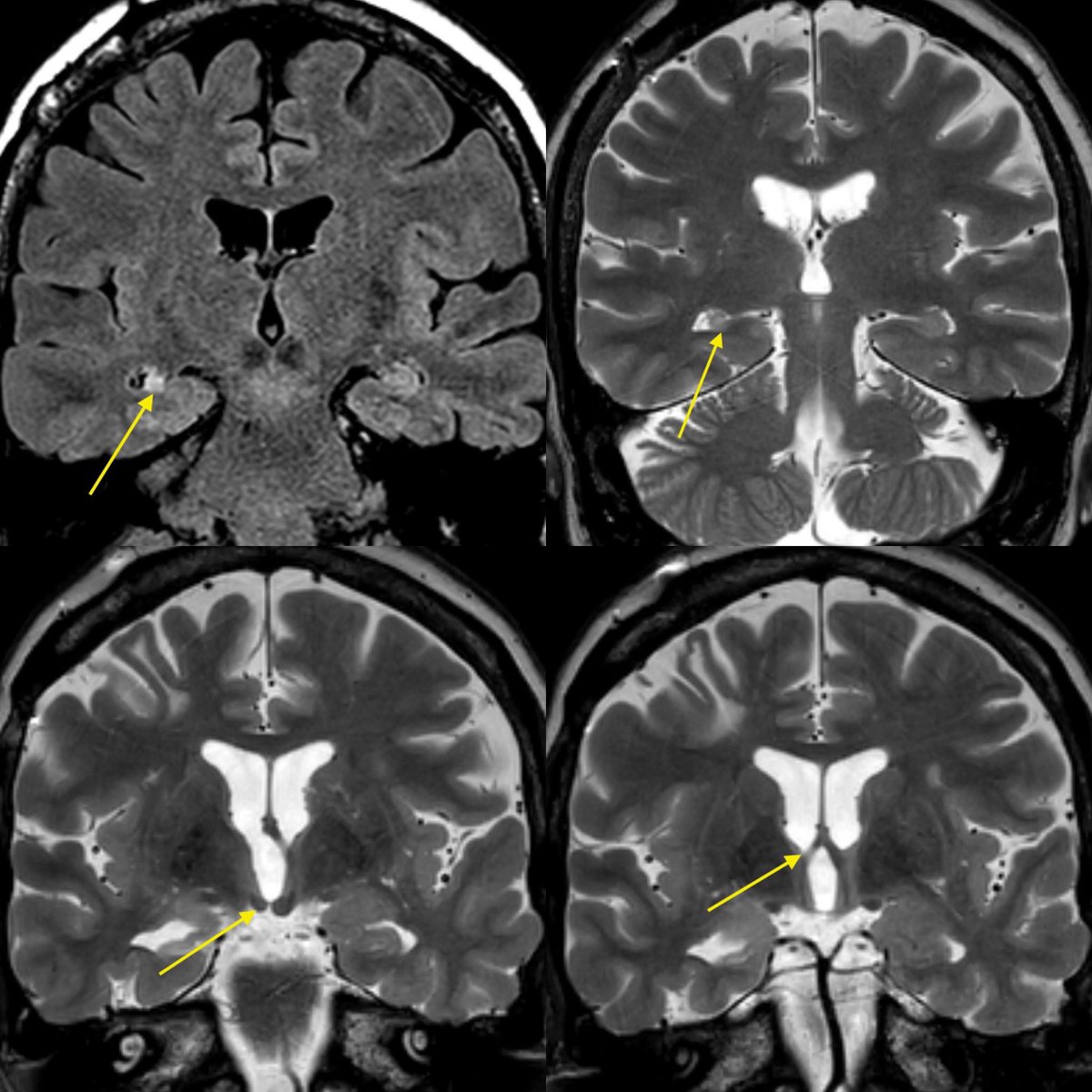 Imaging Quick Tips & Tricks for Cranial Neuropathies 🧠 A neuroimaging 🧵 ...