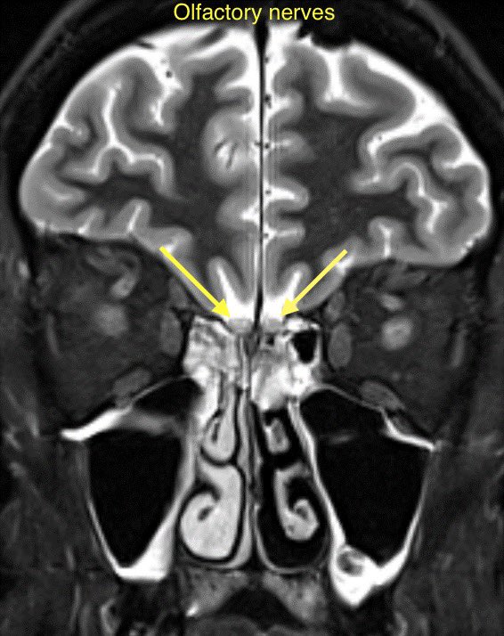 Imaging Quick Tips & Tricks for Cranial Neuropathies 🧠 A neuroimaging 🧵 ...
