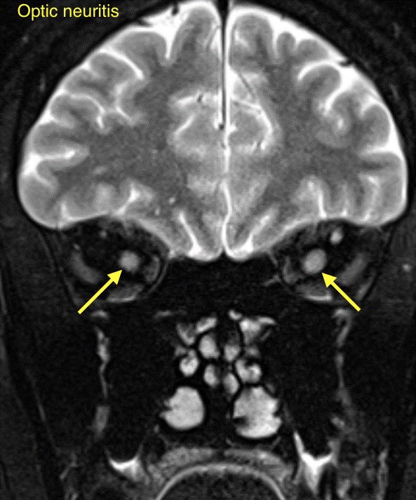 Imaging Quick Tips & Tricks for Cranial Neuropathies 🧠 A neuroimaging 🧵 ...