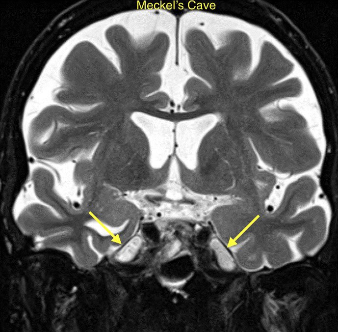 Imaging Quick Tips & Tricks for Cranial Neuropathies 🧠 A neuroimaging 🧵 ...