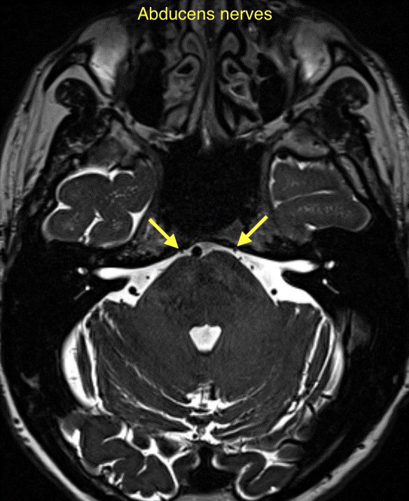 Imaging Quick Tips & Tricks for Cranial Neuropathies 🧠 A neuroimaging 🧵 ...