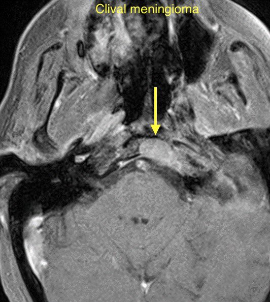 Imaging Quick Tips & Tricks for Cranial Neuropathies 🧠 A neuroimaging 🧵 ...