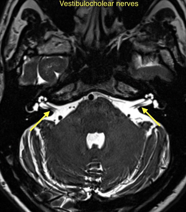 Imaging Quick Tips & Tricks for Cranial Neuropathies 🧠 A neuroimaging 🧵 ...