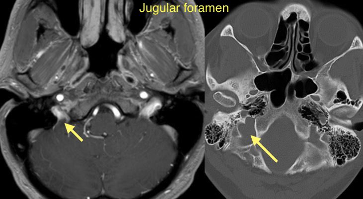 Imaging Quick Tips & Tricks for Cranial Neuropathies 🧠 A neuroimaging 🧵 ...