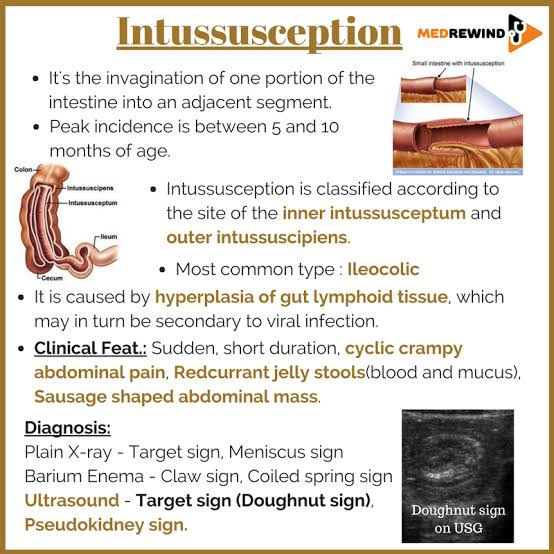 Intussusception Barium Enema Claw Sign