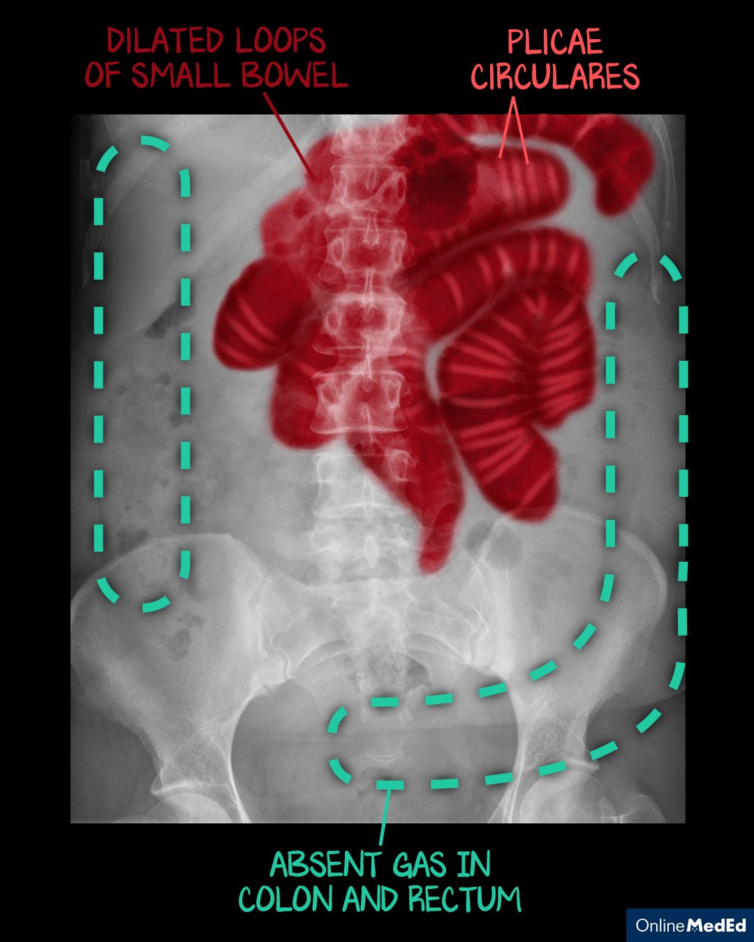 Plicae Circulares X Ray