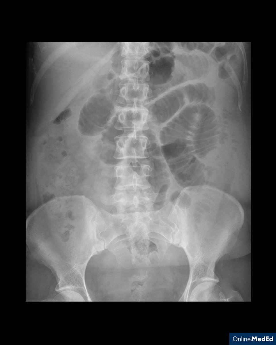 Plicae Circulares X Ray