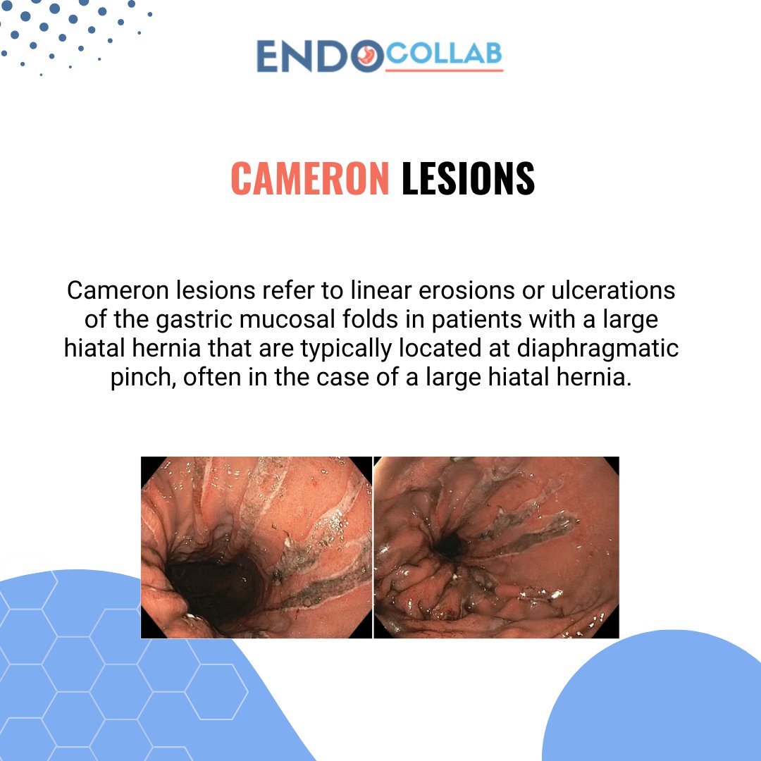 Cameron Ulcer Esophagus JaypeeDigital | EBook Reader