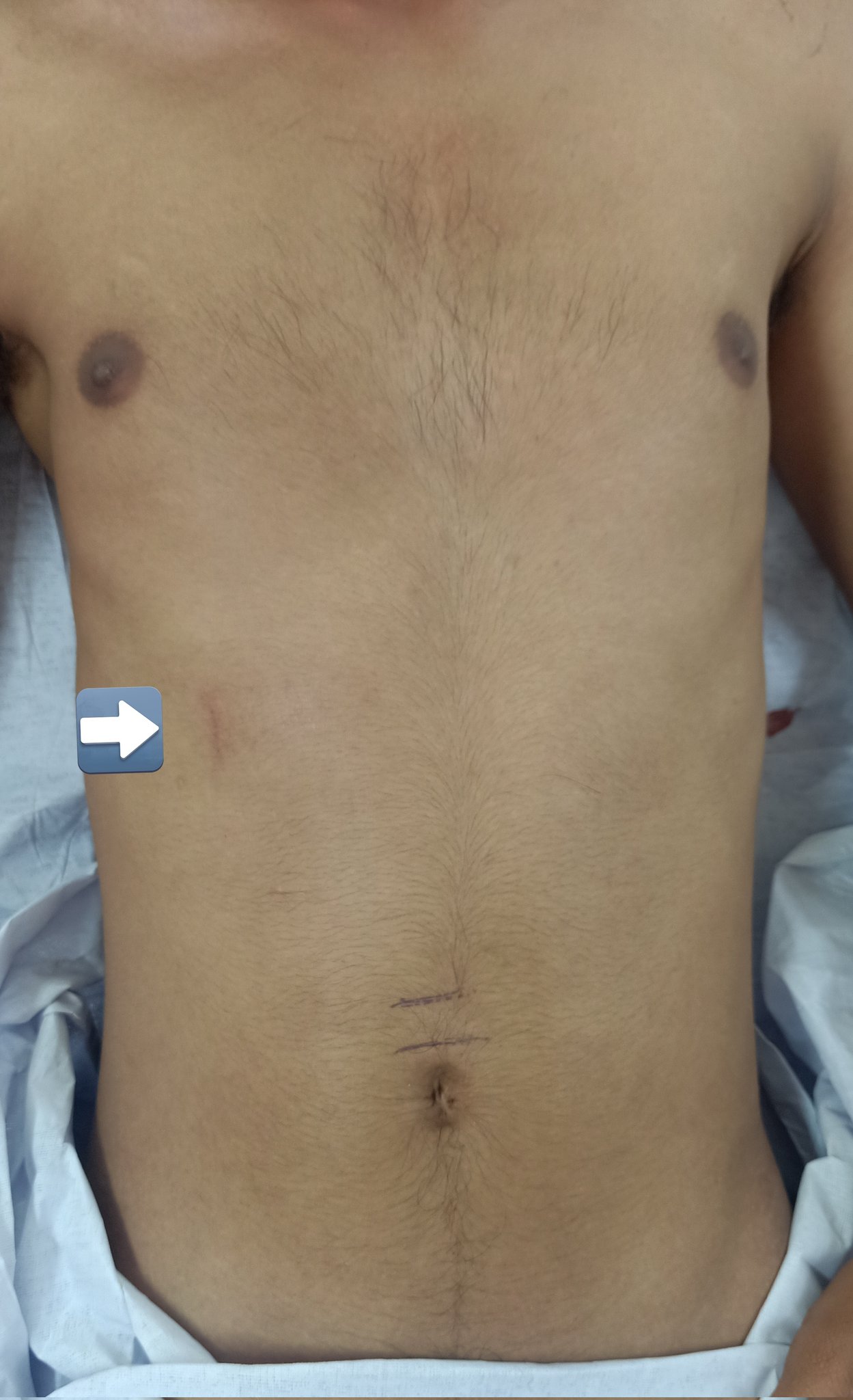 Abdominal Bruising