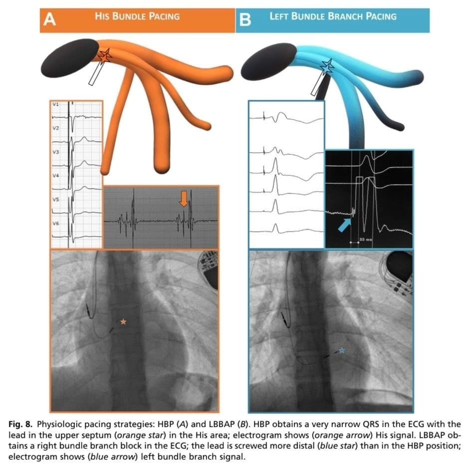 💥 Left Bundle Branch Block https://t.co/9k4znpVdnT #CardioEd # ...