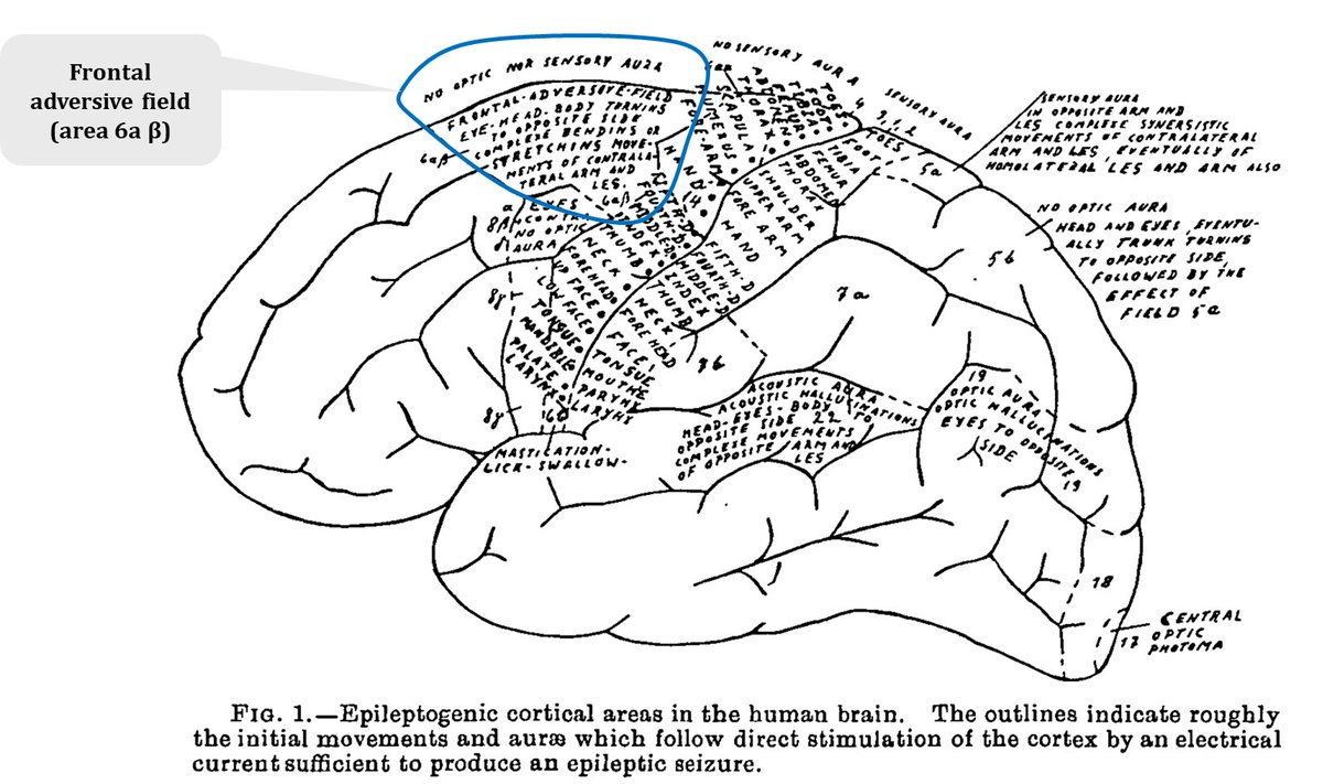 SEIZURE SEMIOLOGY #TWEETORIAL #Epilepsy #Seizure #NeuroX 🧵1. What is ...