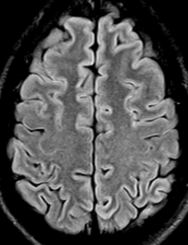 The perirolandic cortex normally has relatively low signal on T2/FLAIR ...