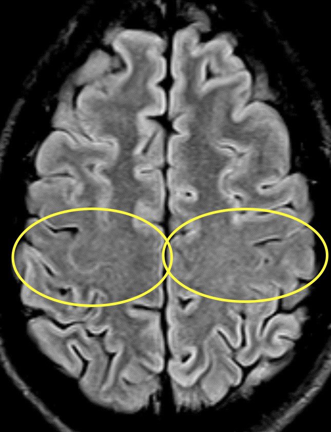 The perirolandic cortex normally has relatively low signal on T2/FLAIR ...