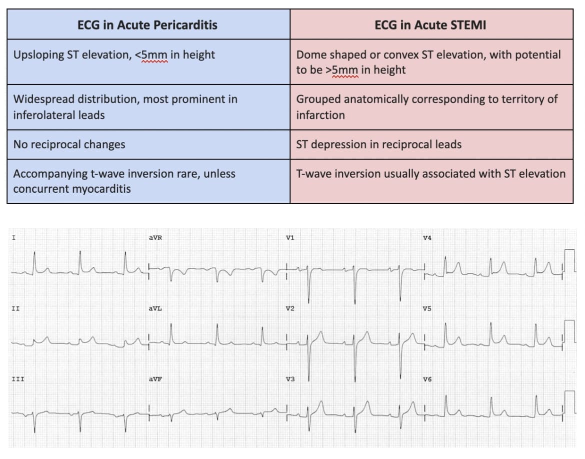 Pericarditis Vs Stemi Ecg Early Repolarization Or Anterior STEMI | ECG