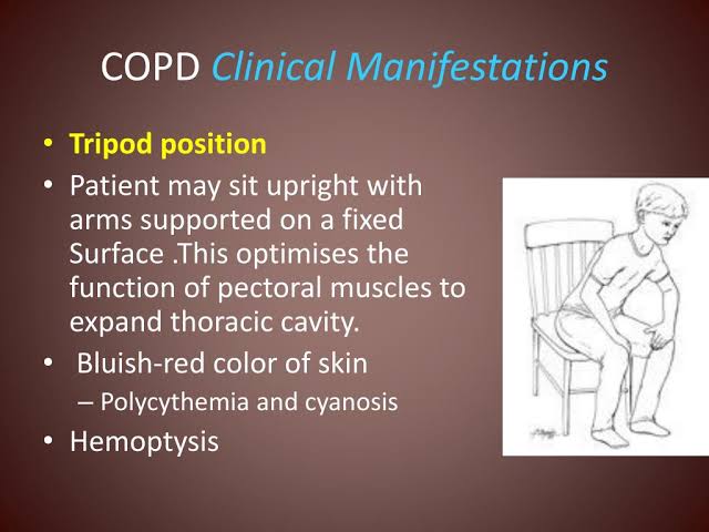 Tripod Position Copd