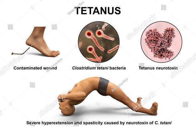 @fasc1nate Severe complications of tetanus can be life-threatening ...