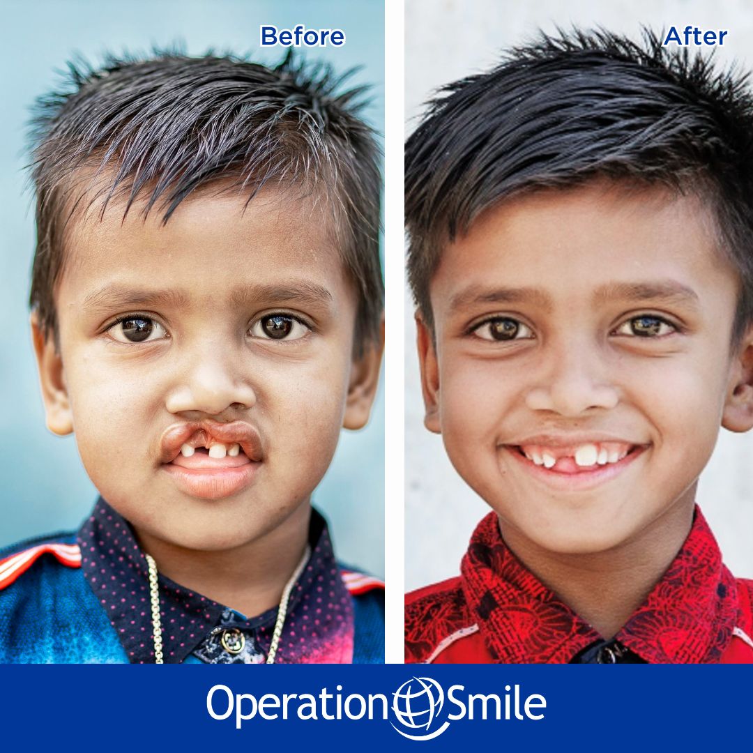 Oporation Smile