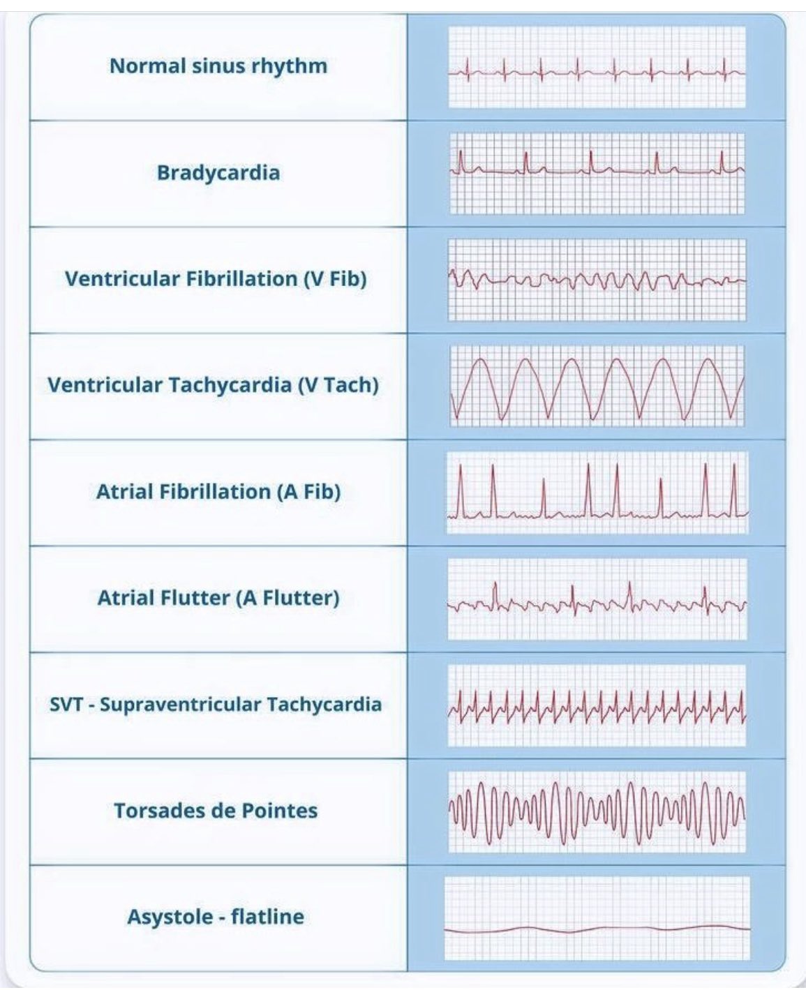 Basic Ekg Rhythms 5 Step Process To Rhythm Interpretation Code One
