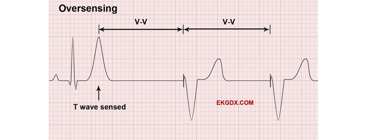 1/ Today's 🧵 is about the #pacemaker basics. The objective of this post ...