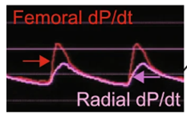 1/11 Invasive arterial blood pressure (IBP) – does the location of ...