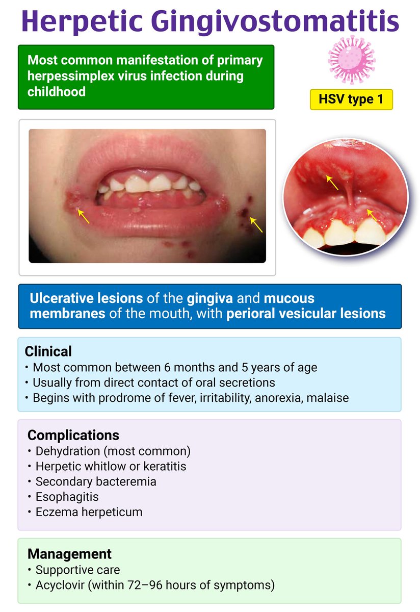 Secondary Herpetic Gingivostomatitis