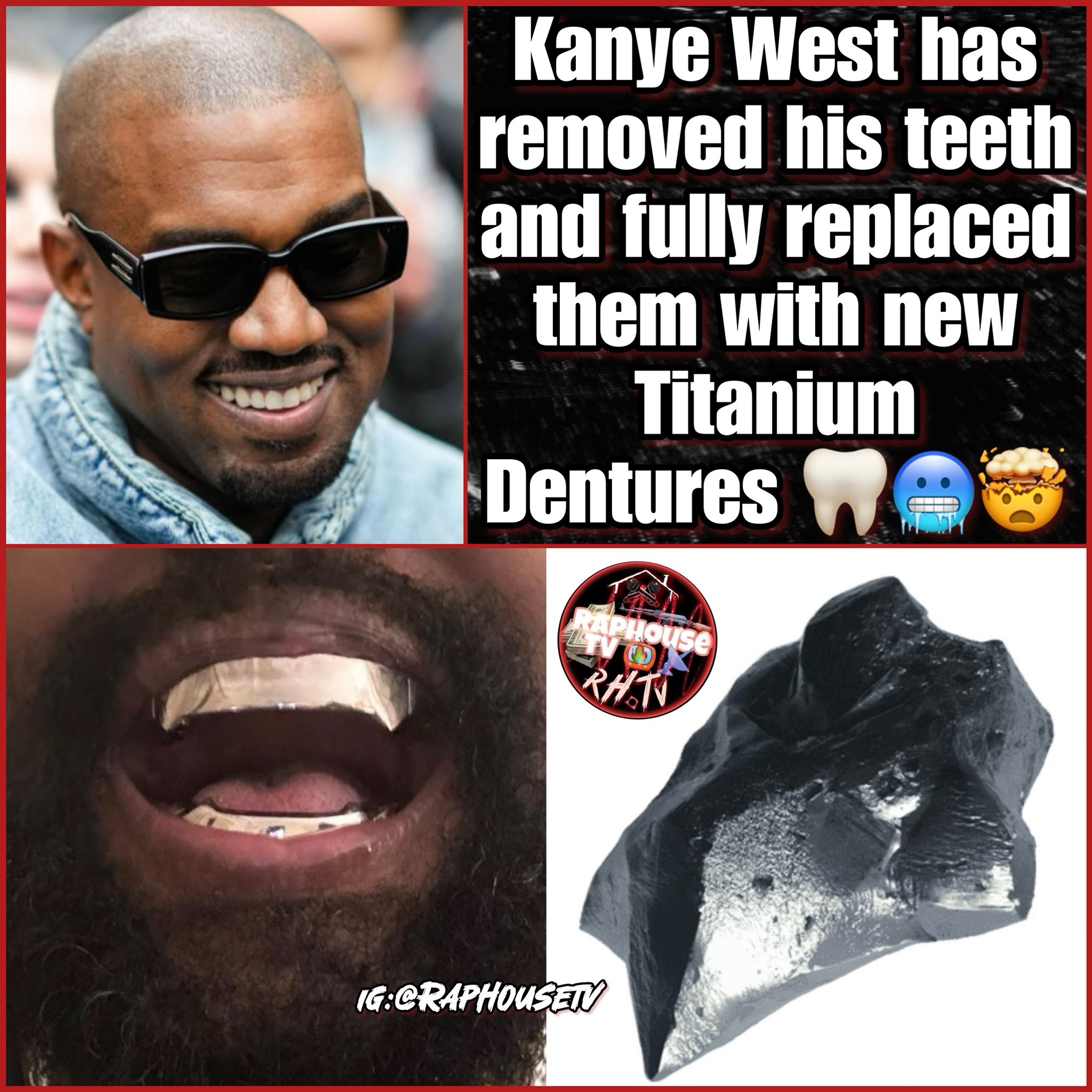 Kanye West Teeth Kanye West Has Replaced His Teeth With TITANIUM 😳