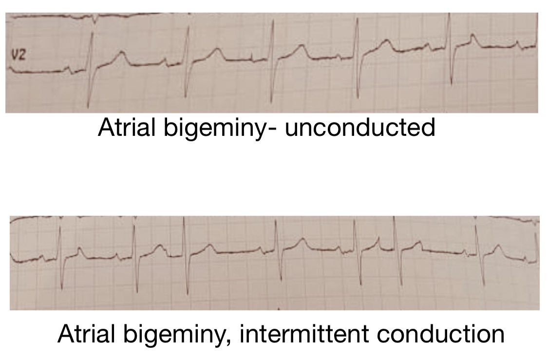 Atrial Bigeminy