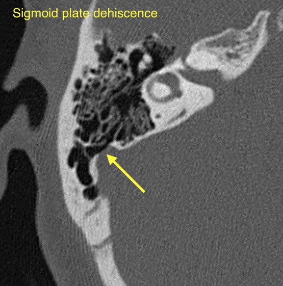 Venous variants and abnormalities are the most common causes of ...
