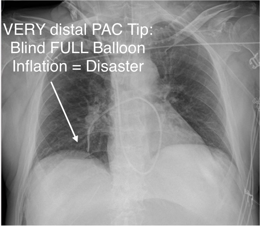 1/10 Avoiding a PA catheter #PAC nightmare! (bookmark this) Evening ...