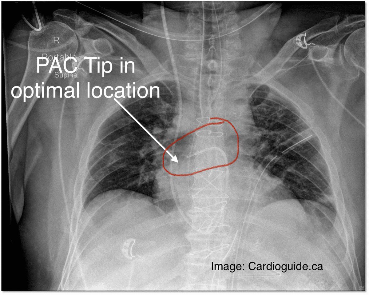 1/10 Avoiding a PA catheter #PAC nightmare! (bookmark this) Evening ...