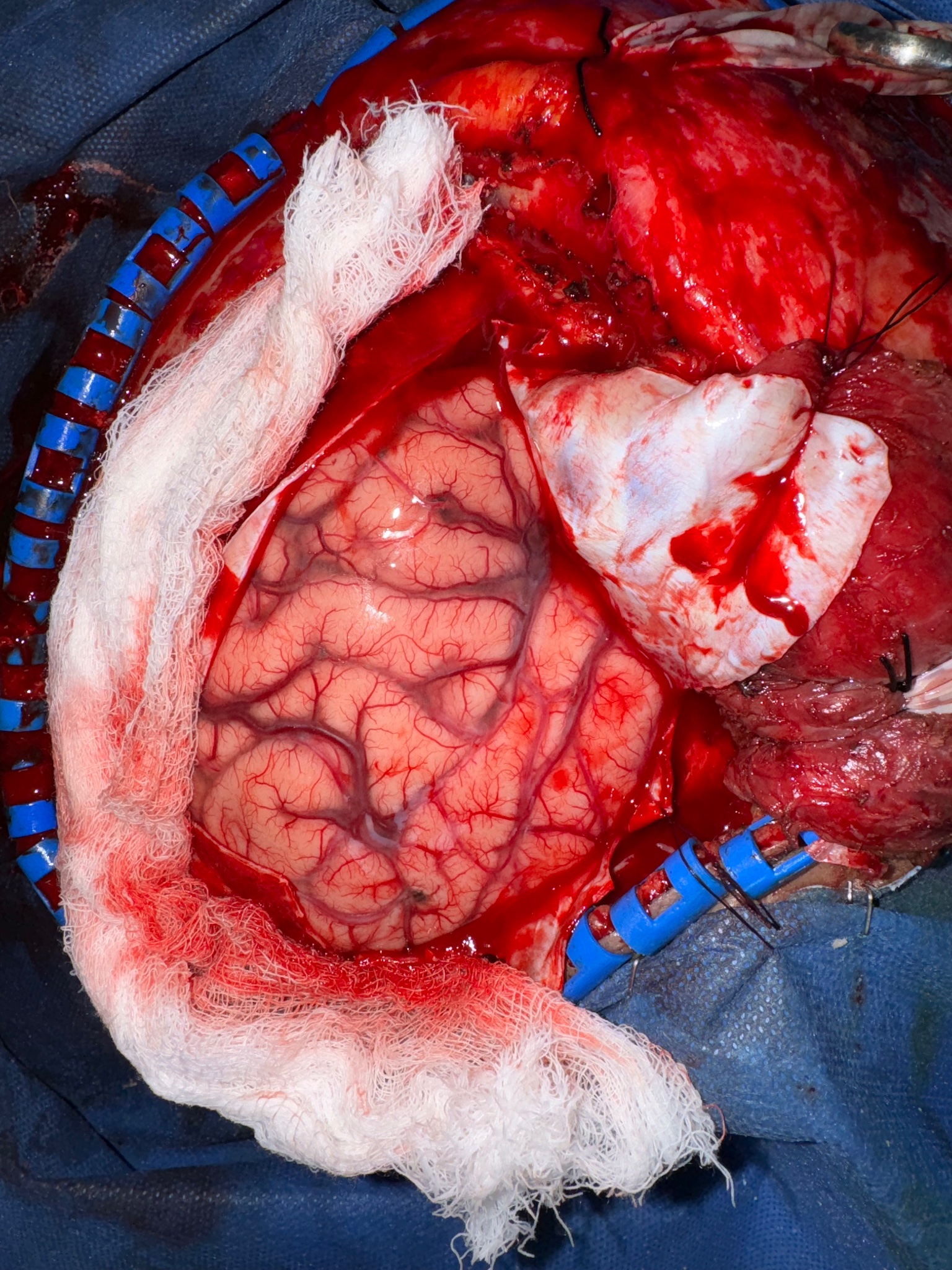 Real Brain Surgery Pictures Closeup Of Brain Surgery; Brain Visible