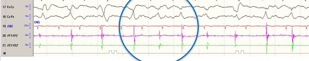 SEIZURE SEMIOLOGY TWEETORIAL (UPDATE) #Epilepsy #NeuroX #Seizure What ...