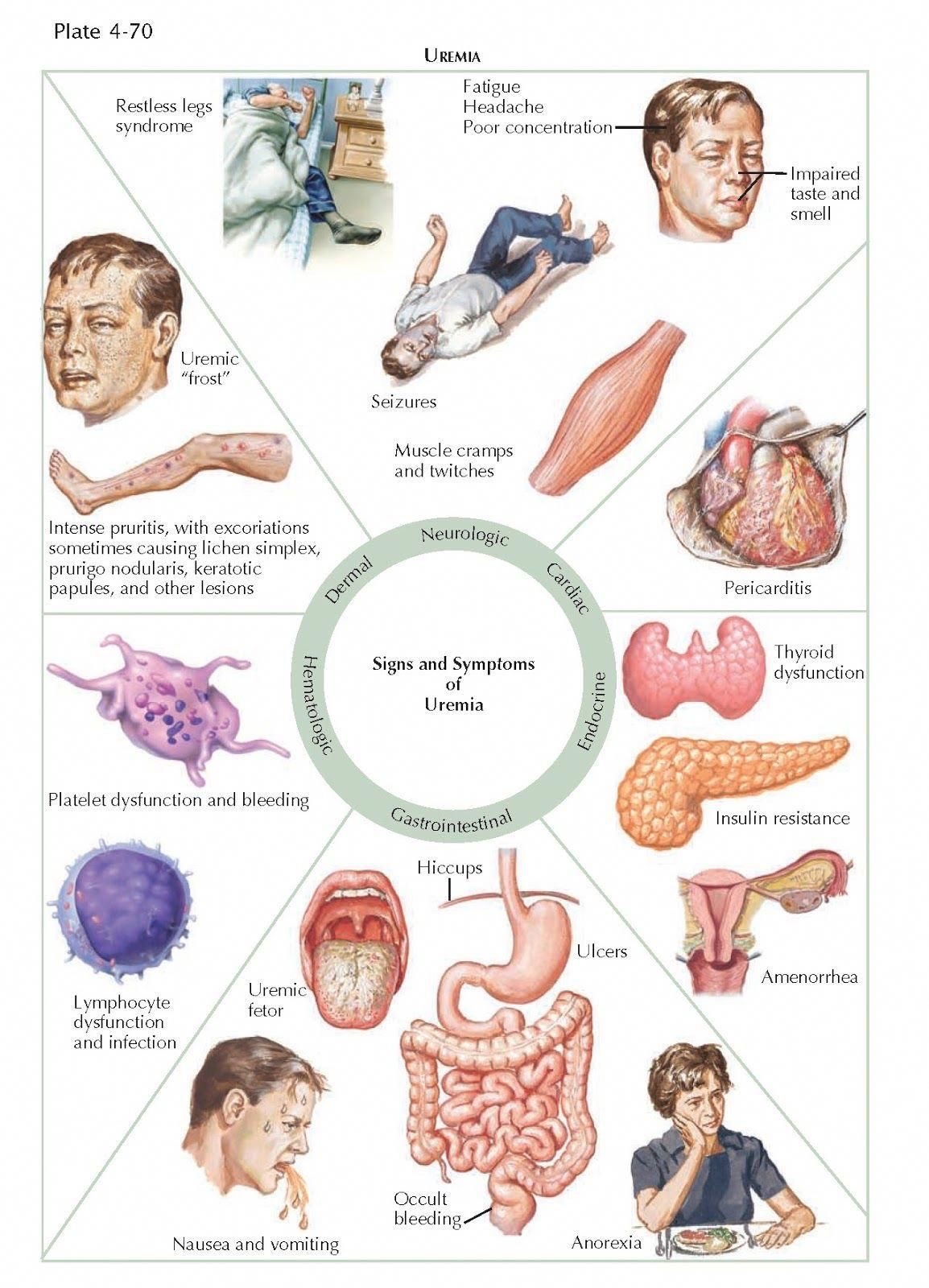 Uremia Signs And Symptoms 138 Uremia Images, Stock Photos, 3D Objects,