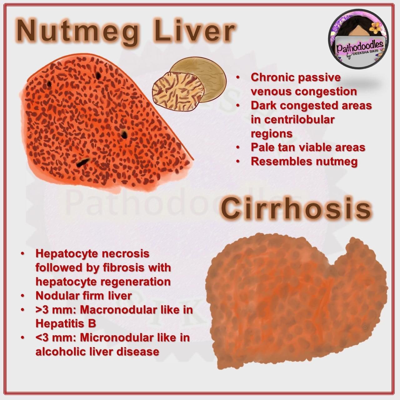 Nutmeg Liver Wikidoc A) Postmortem Example Of The Classical "nutmeg"