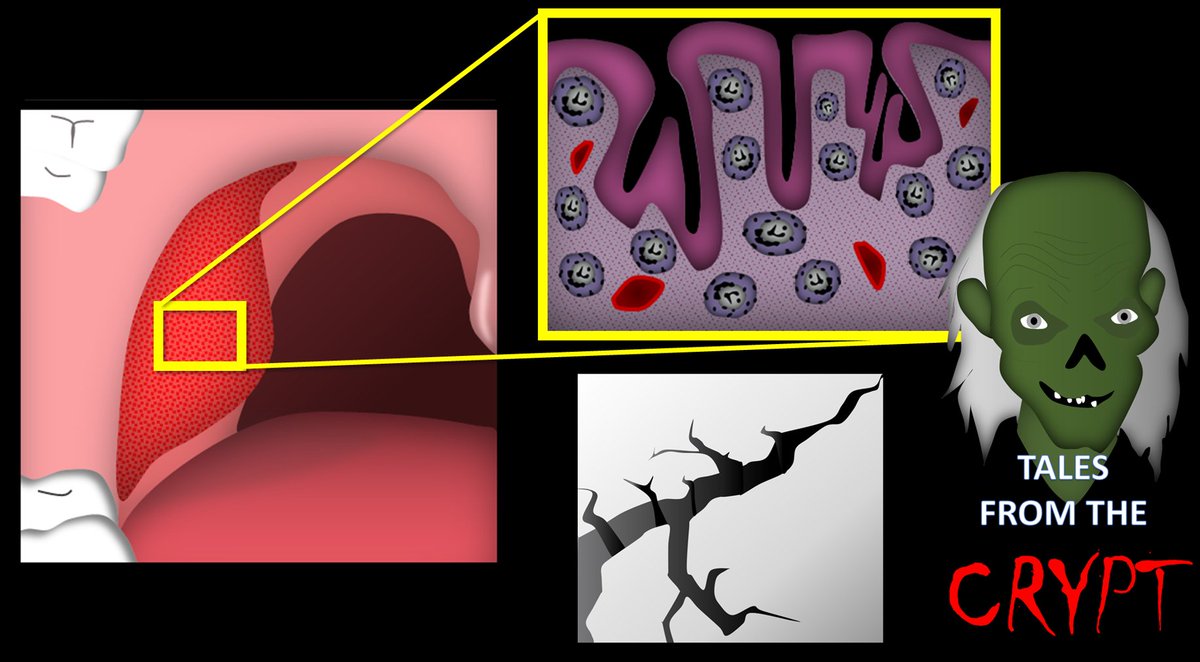 1/Is the never ending debate on tonsillitis becoming hard to swallow ...