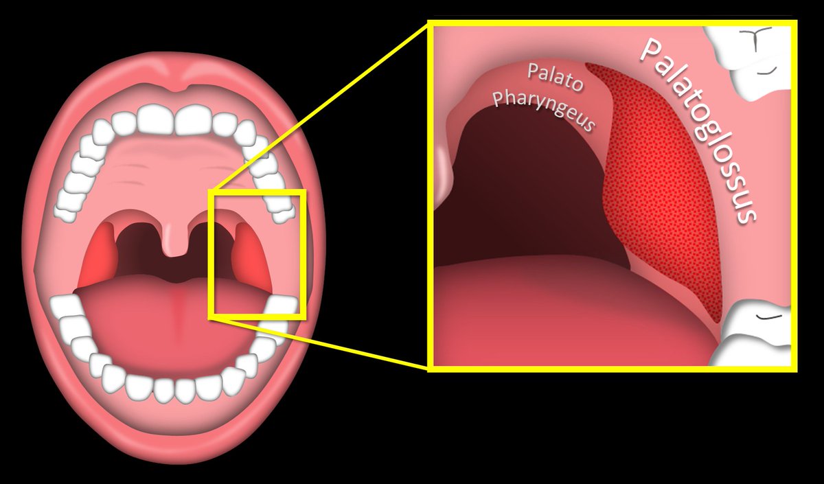 1/Is the never ending debate on tonsillitis becoming hard to swallow ...