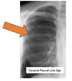 Visceral Pleural Line Pleural Plaques & Asbestos | Risk, Symptoms