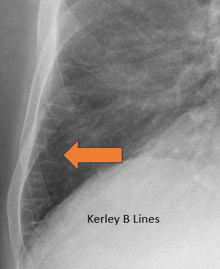 Kerley B Lines On Chest X Ray