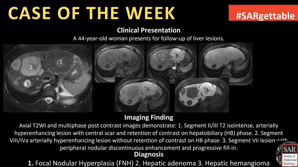 Focal Nodular Hyperplasia Central Scar Focal Nodular Hyperplasia