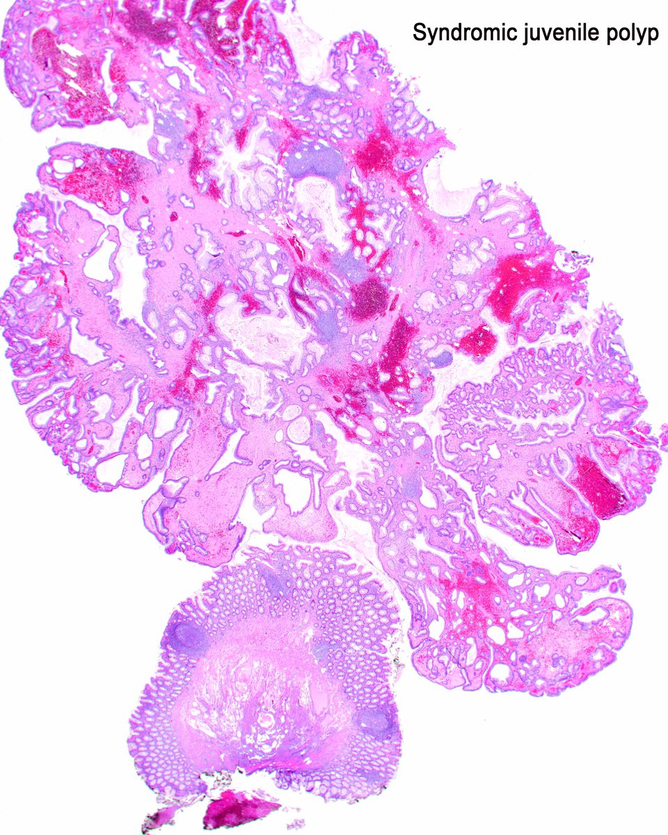 Juvenile Polyp