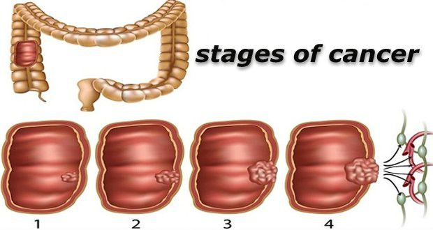 SARATANI YA UTUMBO MPANA NA PURU ( COLORECTAL CANCER) Hii ni aina ya ...