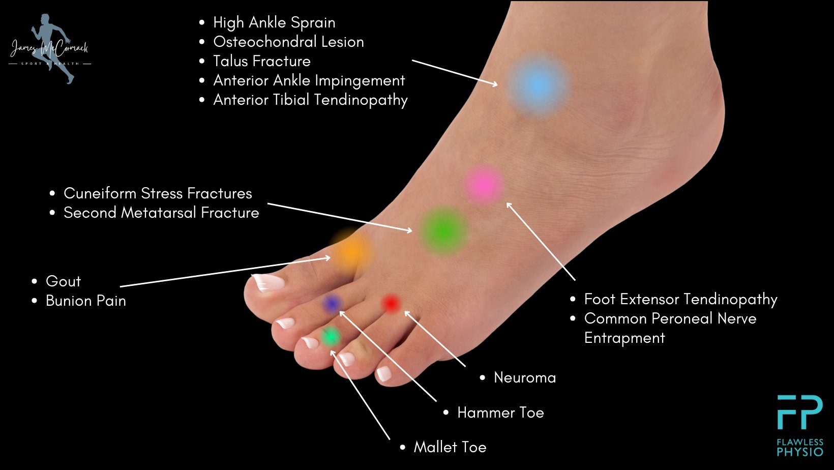 Foot Pain Diagram Plantar Fasciitis: Causes And Treatments To Kick