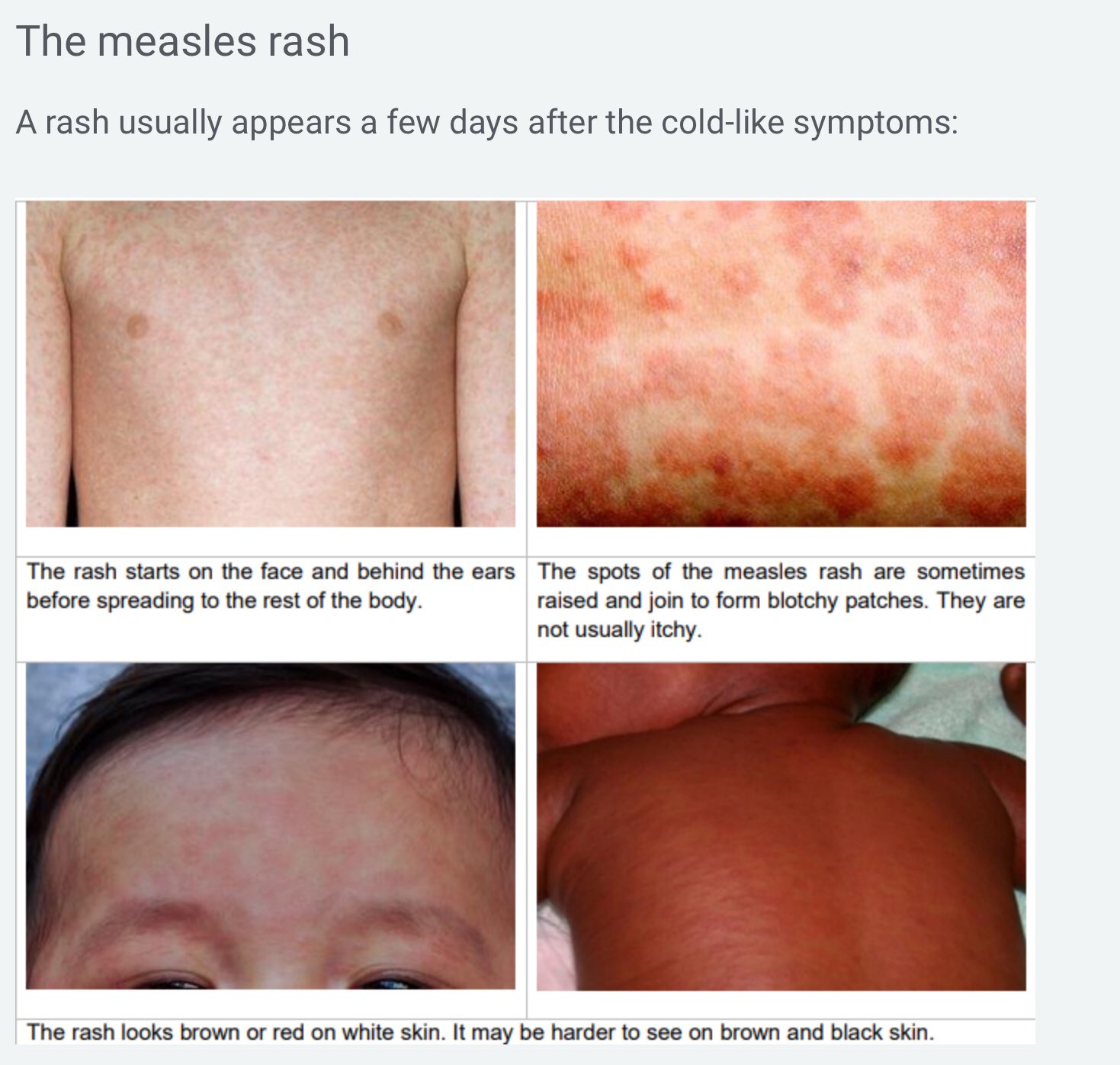 Rubella Rash Behind Ears