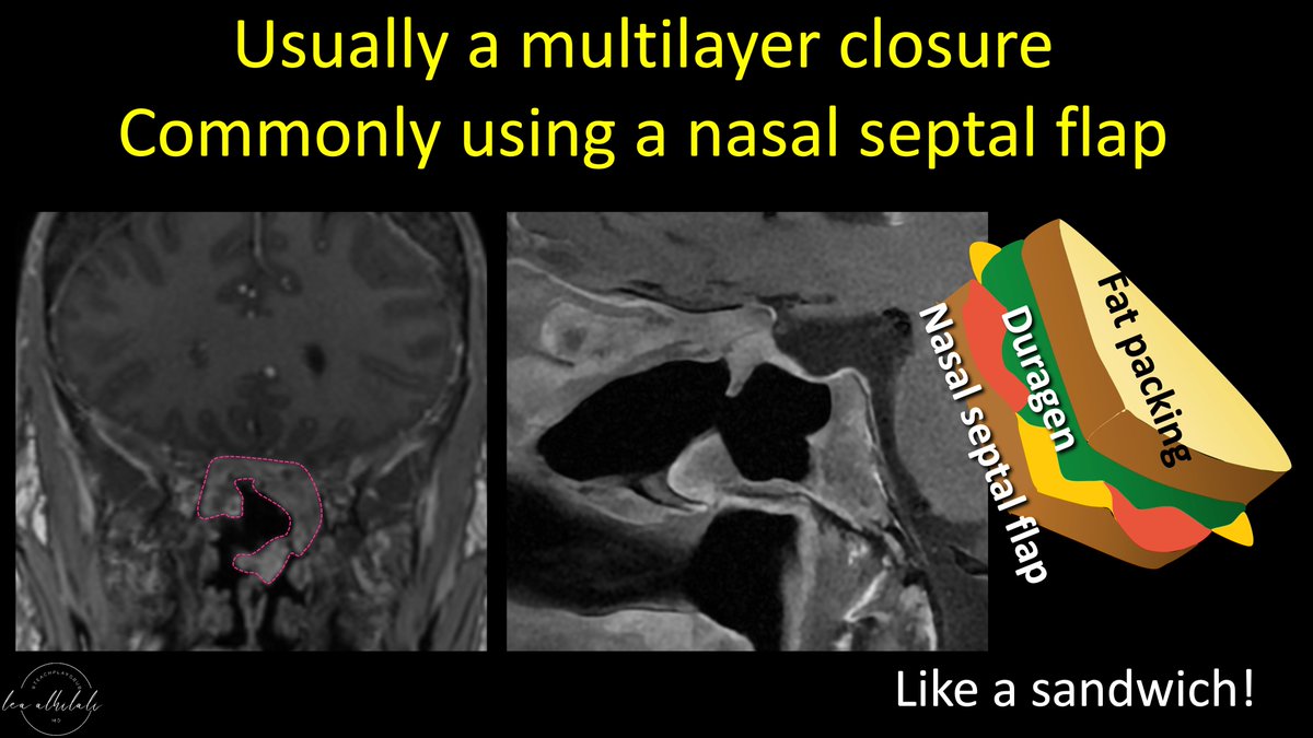 1/Want to understand skull base surgery? Just follow your nose ...