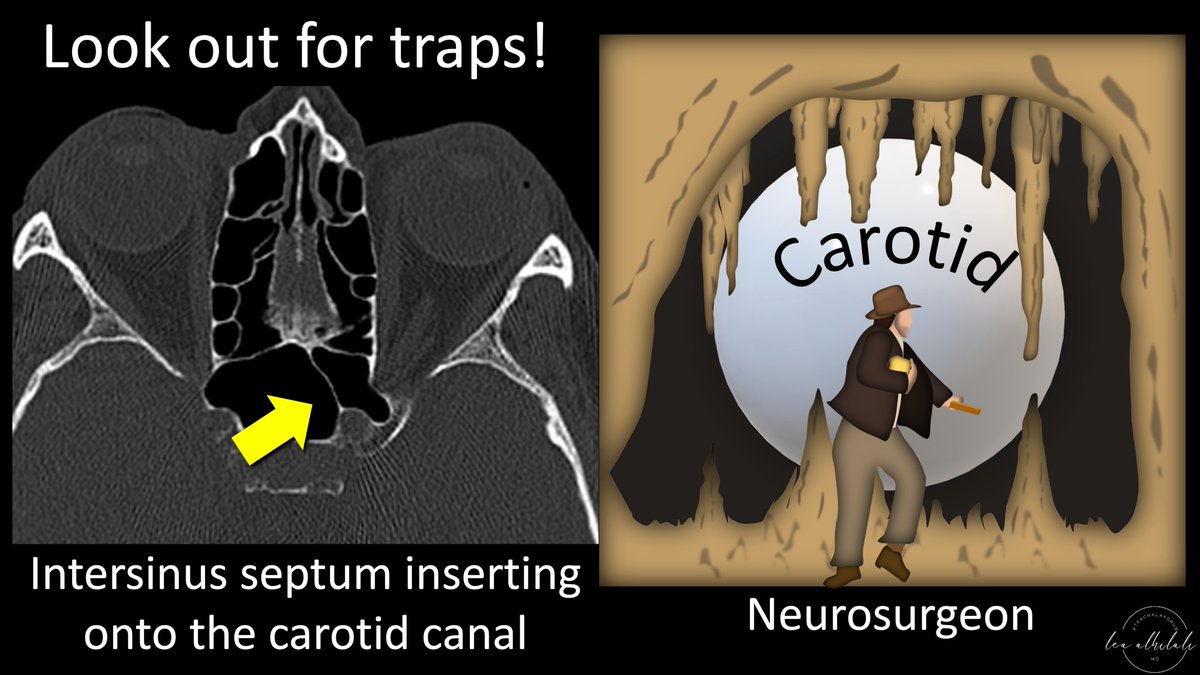 1/Want to understand skull base surgery? Just follow your nose ...