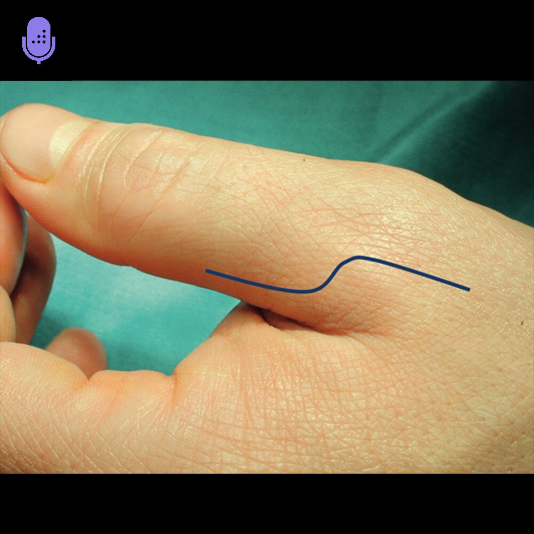 Digital Collateral Ligament Injury Hand Orthobullets Hand Injury