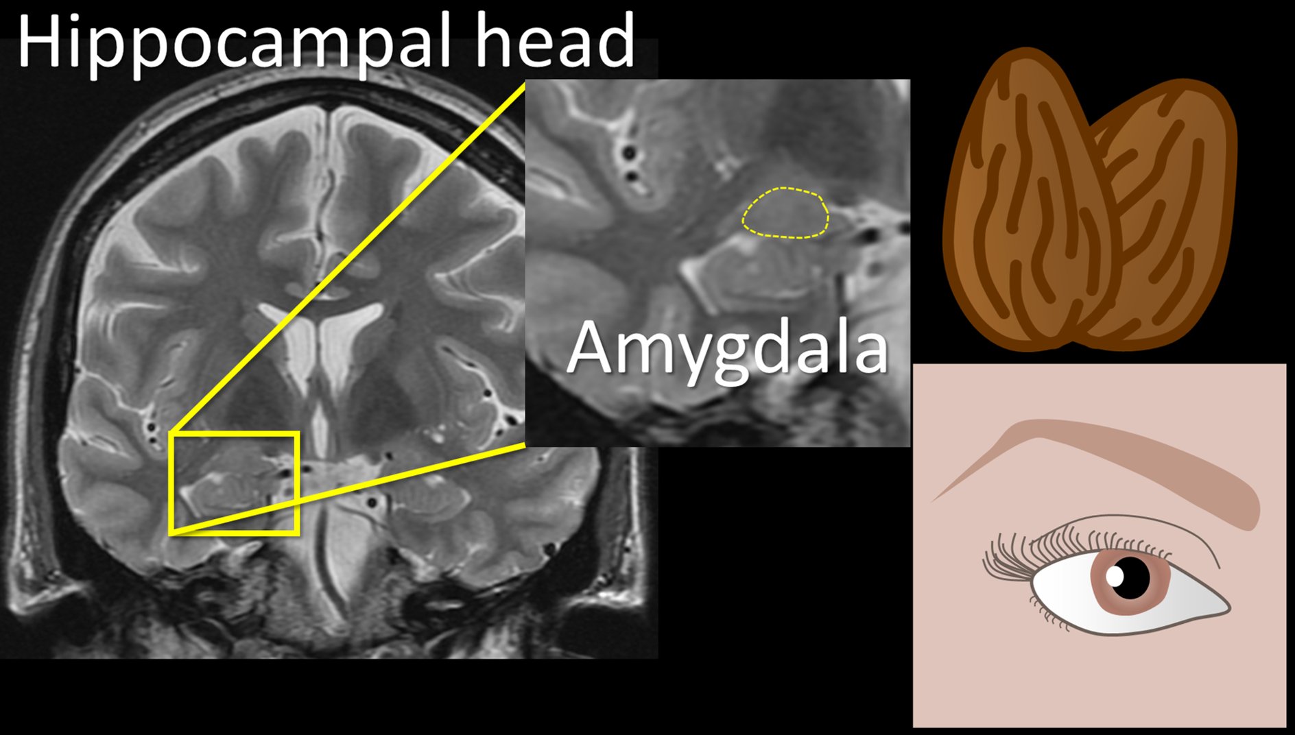 Hippocampus Amygdala Mri