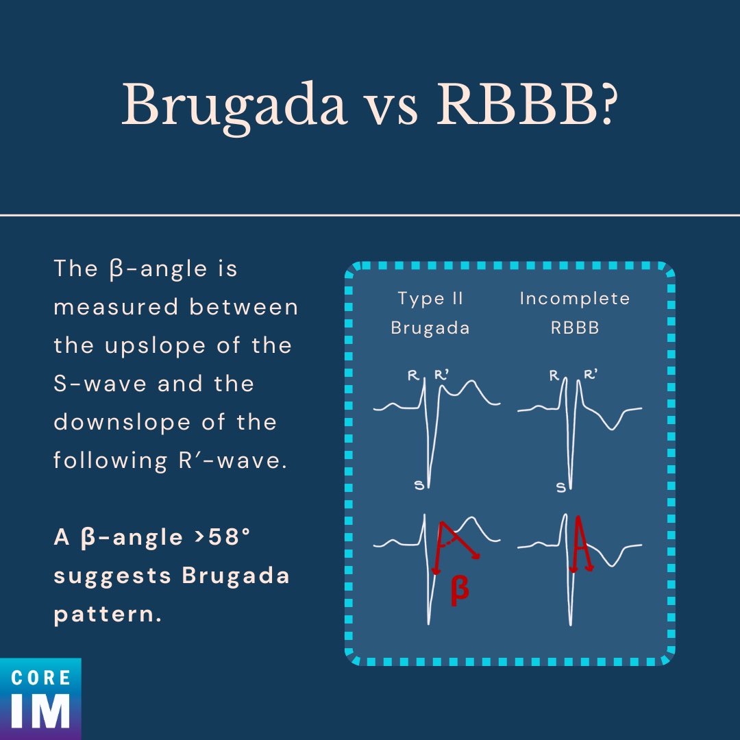 1/ Time for #12LeadThursday! Let’s run through a case! A 35 y/o M with ...
